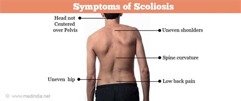 Scoliosis Facts Causes Types Symptoms And Treatment
