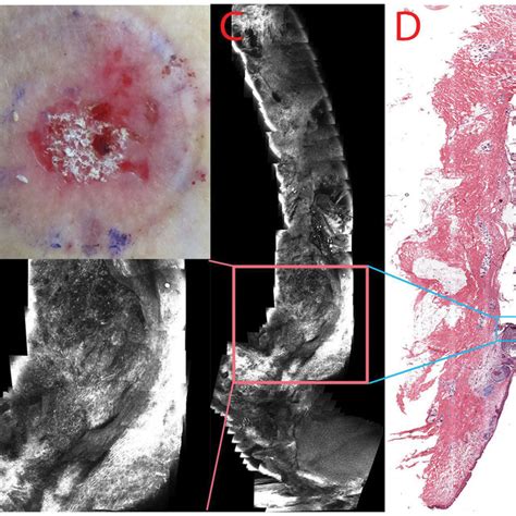 Pre Ablation Imaging And Assessment Of Basal Cell Carcinoma A