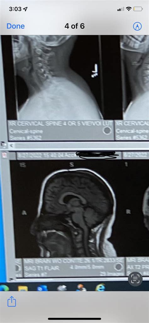 Basilar Invagination R Chiari