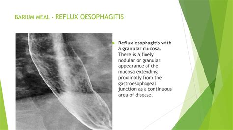Upper Gi Path Smd Pptx On Upper Gi Bleeding Ppt