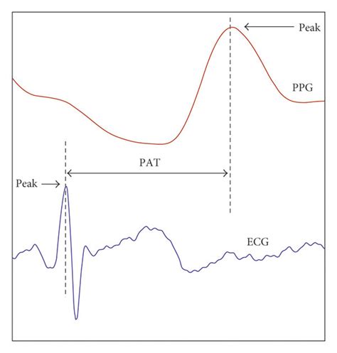 Measurement Of Pulse Arrival Time Pat Using Photoplethysmogram Ppg