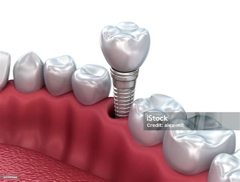 치아 임 플 란 트 의학적으로 정확한 3d 일러스트 화이트 스타일 역할 모델에 대한 스톡 사진 및 기타 이미지 역할 모델 인공적인 치관 Istock