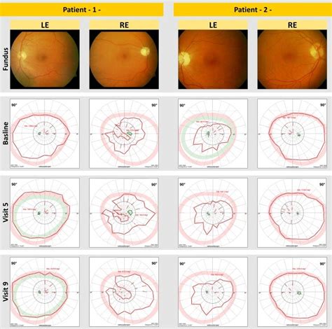 Fundus Photographs And Development Of Visual Field Vf Area In Two