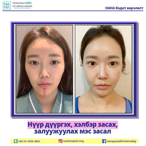 Nana Hospital Солонгосын Nana гоо сайхны эмнэлэг Нүүрний хэлбэр засаж нүүр дүүргэх арьс