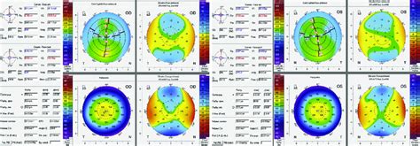 Scheimpflug Based Corneal Topography Showing Sagittal Map Pachymetry Download Scientific