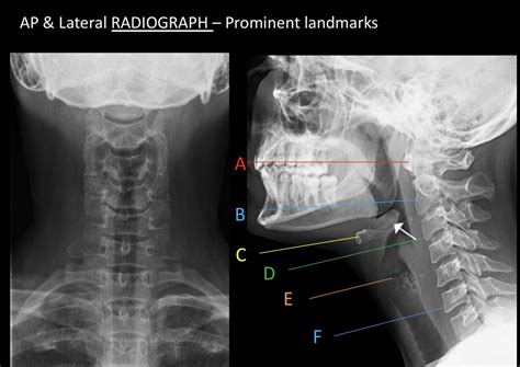 Radiograph Diagram Quizlet Radiograph Diagram Quizlet