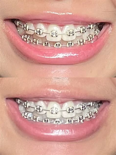 Item ลดฟันเหลืองระหว่างจัดฟัน 🦷🪥 กลับมายิ้มแบบมั่นใจ 🌟 แกลเลอรีที่โพสต์โดย Kkacha Lemon8