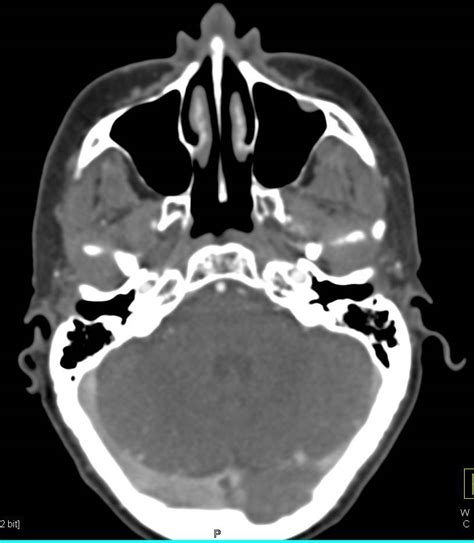 Normal Cta Of The Head And Neck Neuro Radiology Case Studies Ctisus