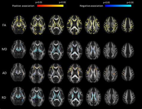 Effect Of Intracranial Volume Icv On White Matter Microstructure A Download Scientific