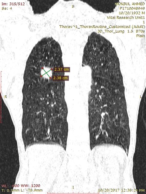 Pulmonary Nodule Ct Scan And Mri
