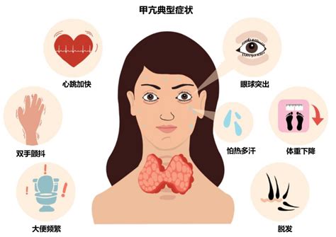 怕热多汗可能是甲亢 知乎