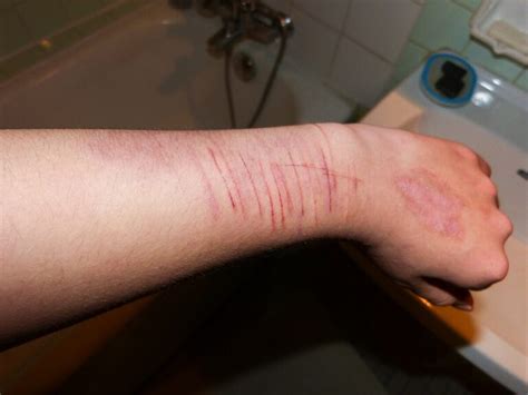 Sangre En El Glande Causas Y Tratamiento