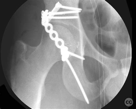 What Is A Posterior Wall Acetabular Fracture At Eva Dolling Blog