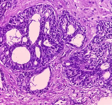 Prostatic Chips Turp Adenocarcinoma It Reveals An Infiltrating Adenocarcinoma Prostate