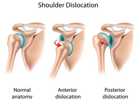 Shoulder Dislocation Shoulder Instability Shoulder Specialist
