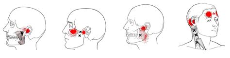 Sternocleidomastoid Trigger Points