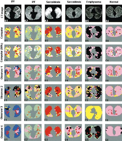 Classification Results Of The Six Lung Patterns Using A Pixel Block