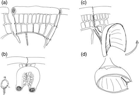 Bladder Augmentation In Anuric Defunctioned Microbladders And A Novel