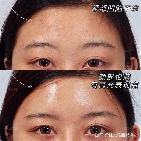 自体脂肪填充额部术后一周效果 知乎