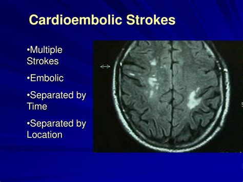 Ppt Cardioembolic Stroke Powerpoint Presentation Free Download Id 3385234