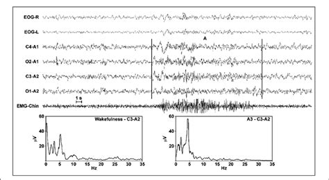 Cyclic Alternating Pattern A3 Subtype Characterized By Predominant Download Scientific Diagram