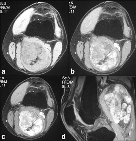 Fat Saturation Axial Ffe T1 Weighted Sequences Before Gadolinium Download Scientific Diagram