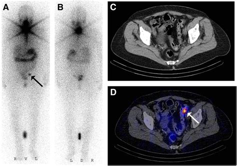 Spectct Journal Of Nuclear Medicine