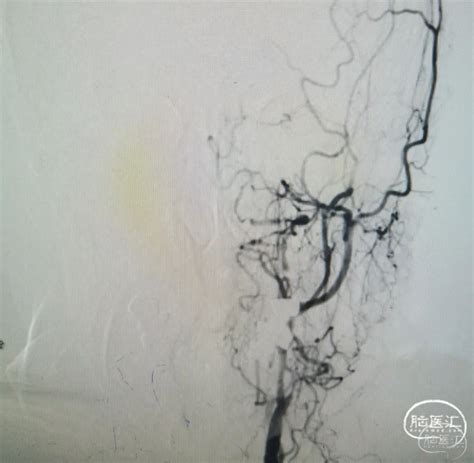 【病例夹】大脑前动脉a1段动脉瘤的介入治疗 脑医汇