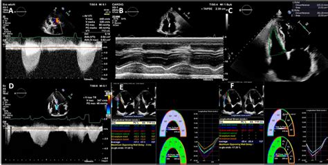Example Of Echocardiographic Assessment Of Right Ventricular RV Download Scientific Diagram