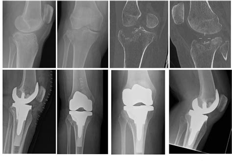 Figure 1 From Acute Total Knee Arthroplasty For Unicondylar Tibial Plateau Fracture Using