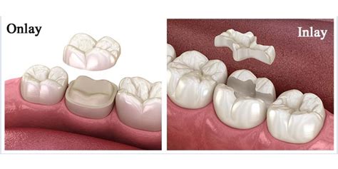 The Difference Between Crowns Fillings Inlays Onlays