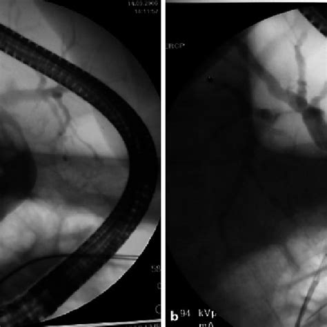 A Cholangiography And Common Bile Duct Cannulation With The Instrument