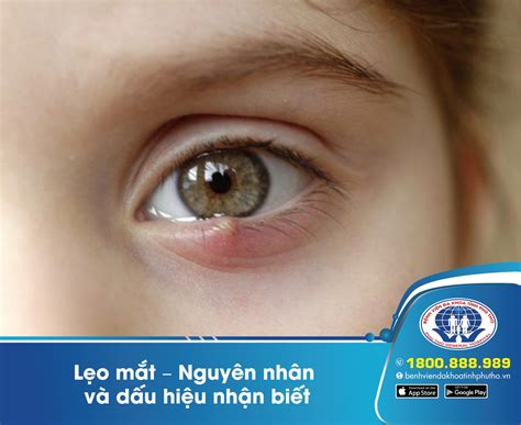 Lẹo Mắt Nguyên Nhân Và Dấu Hiệu Nhận Biết