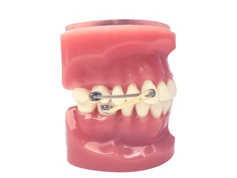 Decoding The Success Of The Class Ii Corrector In Treating Bite Misalignment Odl Orthodontic Labs