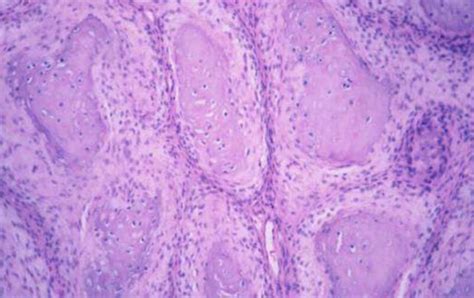 Pathology Block 11 With Pics Flashcards Quizlet