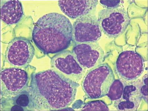 Morphological Examination Of The Bone Marrow Showing Active Bone Marrow