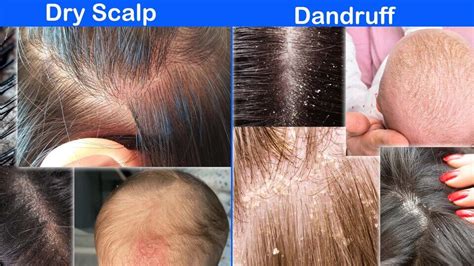 Dandruff Vs Dry Scalp Differences Similarities And Treatment