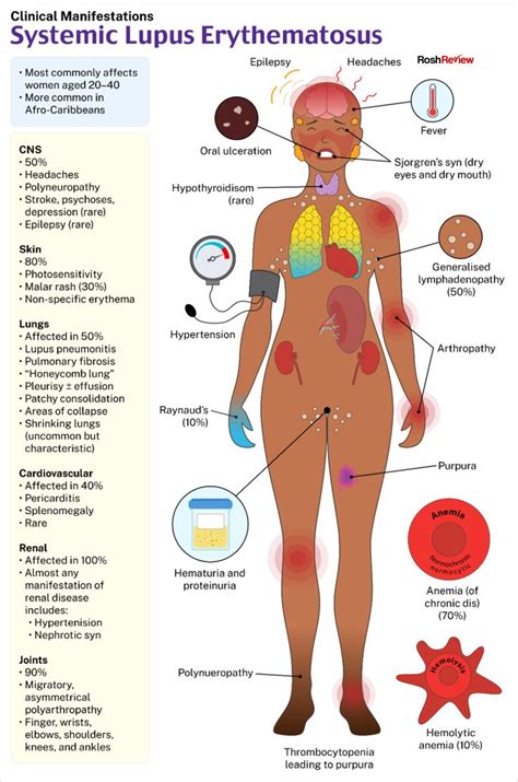Systemic Lupus Erythematosus
