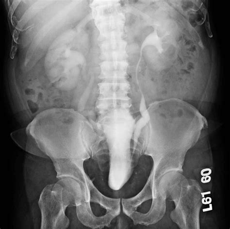 Figure 1 From Practical Uroradiologypelvic Lipomatosis Semantic Scholar