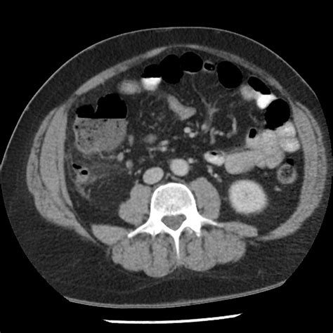 Interventional Radiology Appendicitis At Jennifer Carranza Blog