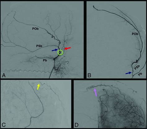 Foramen Spinosum Middle Meningeal Artery Middle Meningeal Artery