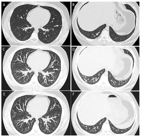 Osteosarcoma Metastasis To The Thorax A Pictorial Review Of Chest