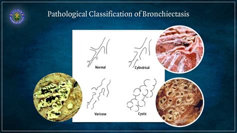 Bronchiectasis Causes And Diagnosis