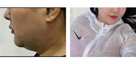 파워v얼굴지방흡입 이중턱근육묶기 14개월차 후기 닥터정 리반의원 파워v얼굴지방흡입 이중턱근육묶기 14개월차 후기 닥터정 리반의원