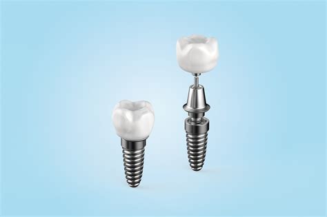 알기 쉬운 임플란트 이야기 임플란트 구조 및 원리