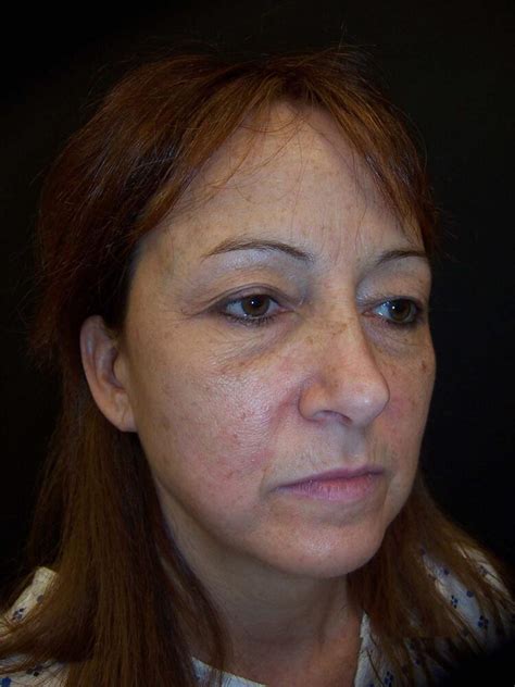 Facial Fat Grafting Before And After Ocss