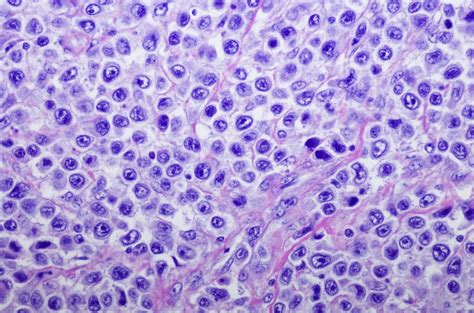 Polatuzumab Vedotin For Relapsedrefractory Diffuse Large B Cell Lymphoma Hematology Advisor