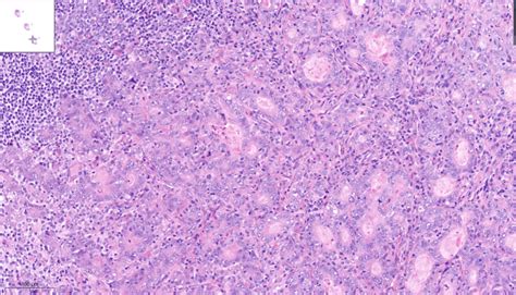 61 Year Old Female With A 12 Mm Flat Elevated Polyp In The Caecum