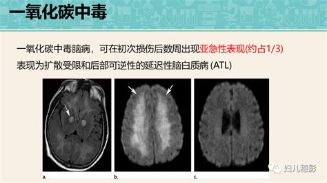 中毒和代谢性脑病的影像诊断 医学界 助力医生临床决策和职业成长