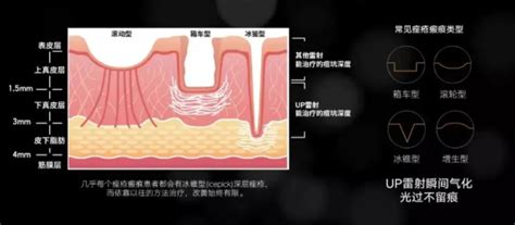采美科普科医人超脉冲点阵王治疗痘坑和瘢痕的黑科技 UP 雷射超脉冲二氧化碳点阵激光采美信息中心
